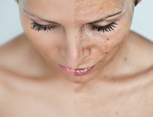 Hyperpigmentation on Back Treatment - Health Care Fix